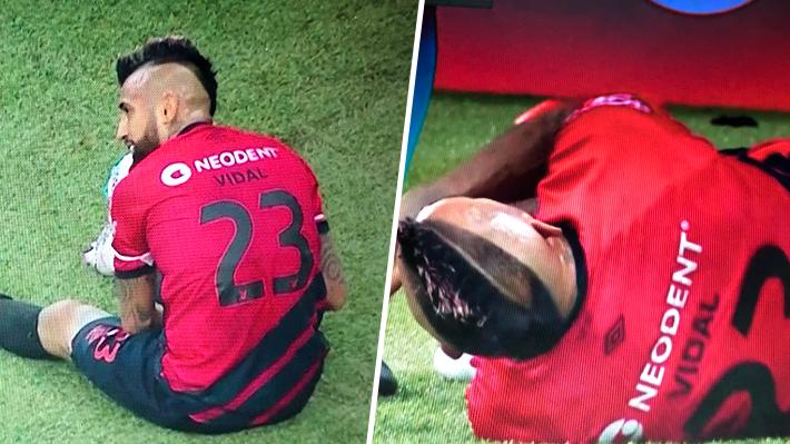 Arturo Vidal salió lesionado en partido de Athletico Parananense en el Brasileirao